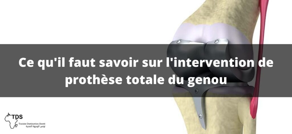 Prothèse totale du genou : tout ce qu'il faut savoir
