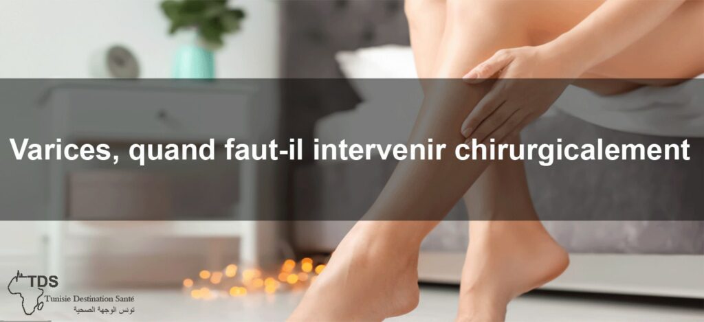 Traitement varice : Moment opportun et options pour la chirurgie