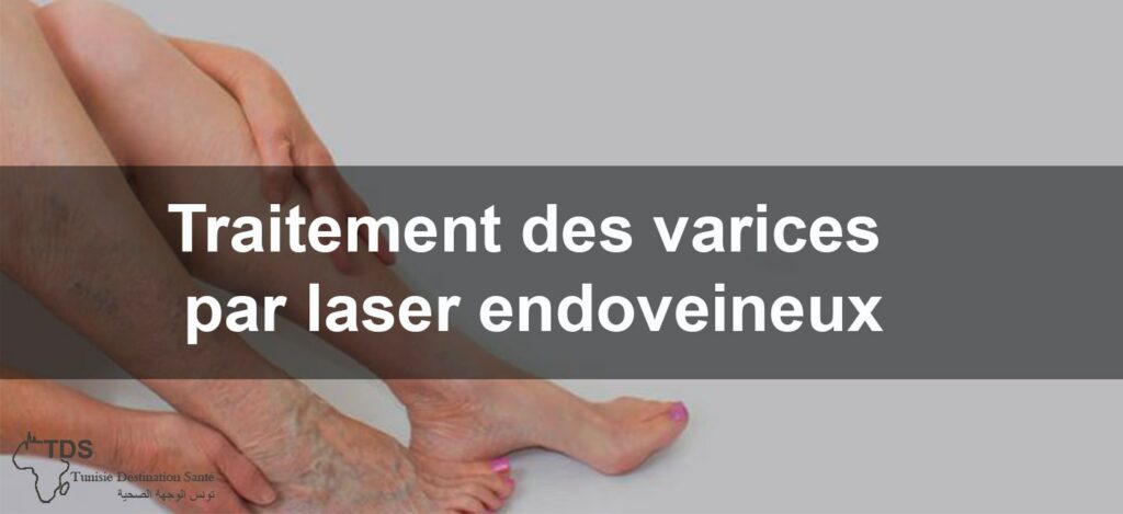 Laser Endoveineux :Traitement des Varices efficace et Sûr
