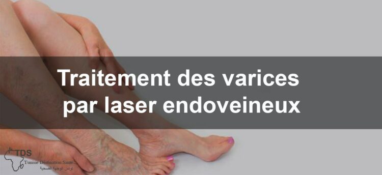 Laser Endoveineux :Traitement des Varices efficace et Sûr