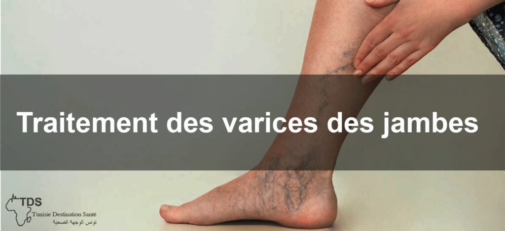 Varices des jambes : Traitement TRAP -Solution définitive