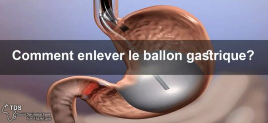 Comment se déroule l'ablation du ballon gastrique