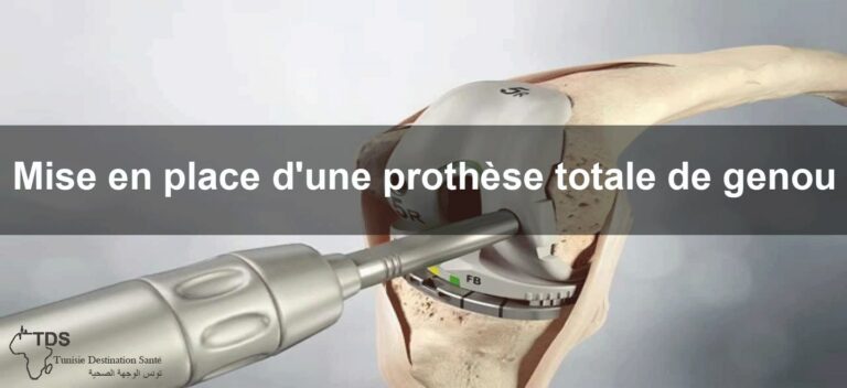 Prothèse totale de genou : Intervention sur le genou