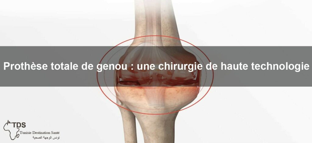 Prothèse totale du genou, la technologie au service des patients