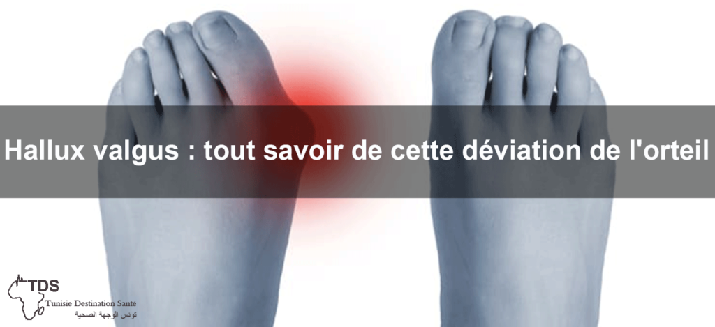 Hallux valgus (oignon au pied) : symptômes, causes et évolution