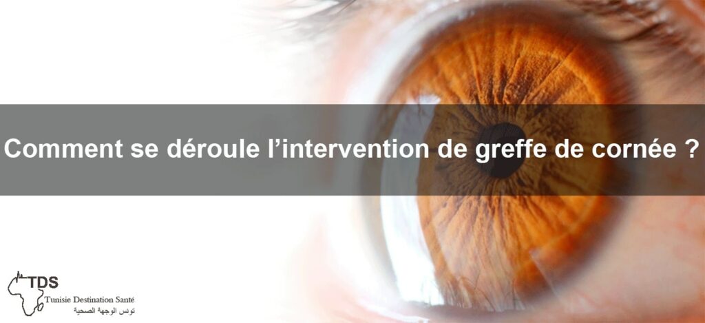 Greffe de cornée : Procédure et déroulement