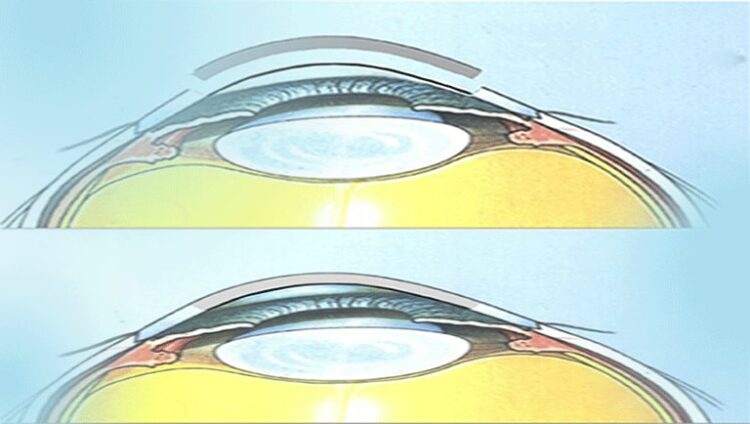 Greffe de cornée : Procédure et déroulement