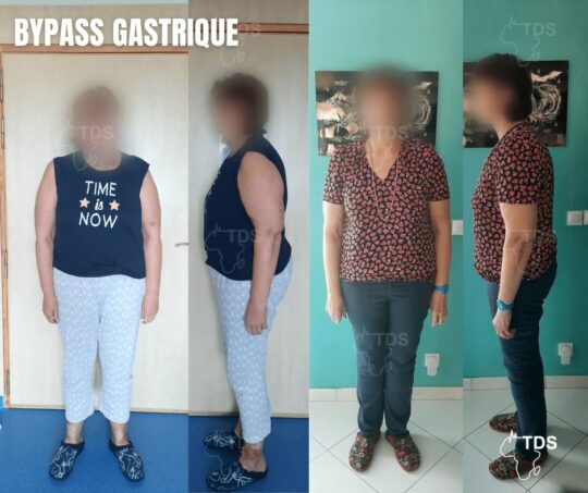 Avant Après Chirurgie Obésité : Découvrez les Transformations
