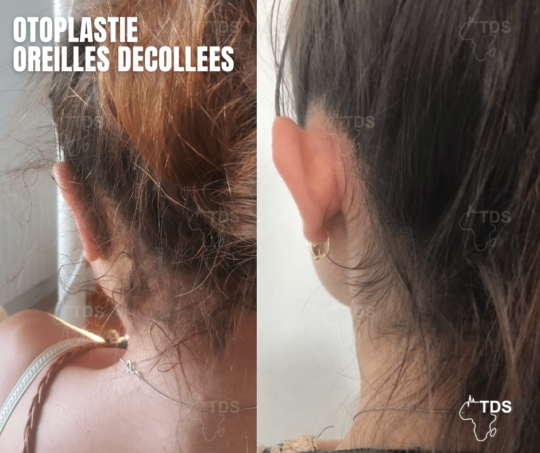 Otoplastie Tunisie : prix chirurgie oreilles décollées