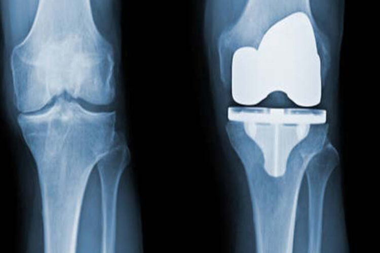 Prothèse du genou : indications, procédure et récupération